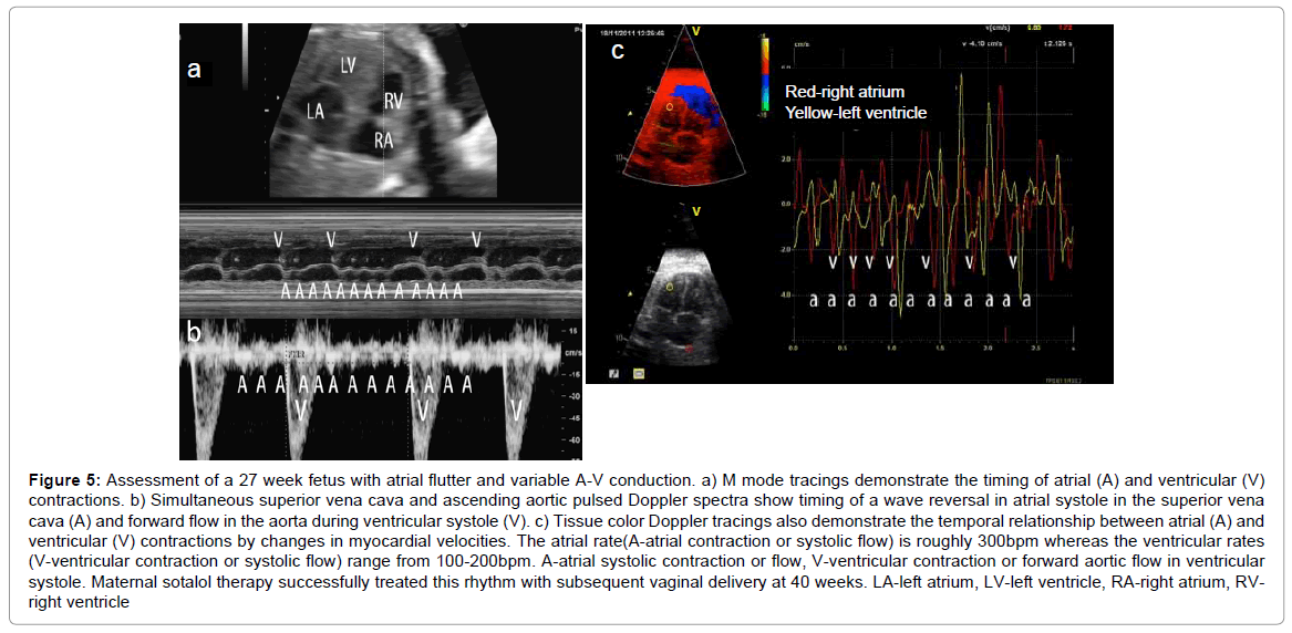 clinical-experimental-cardiology-atrial-flutter