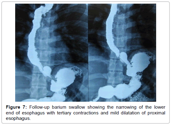 general-medicine-esophagus-tertiary-contractions