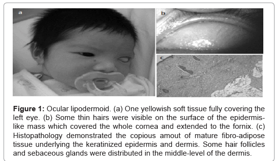 neonatal-biology-Ocular-lipodermoid