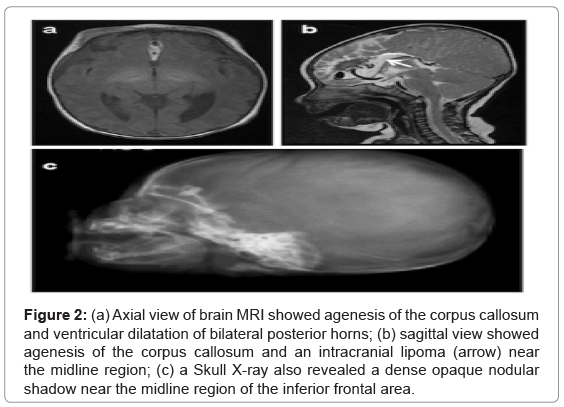 neonatal-biology-corpus-callosum